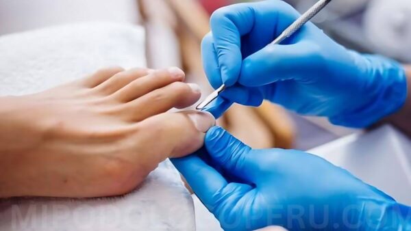 ¿Cómo curar un uñero en el dedo gordo del pie infectado?